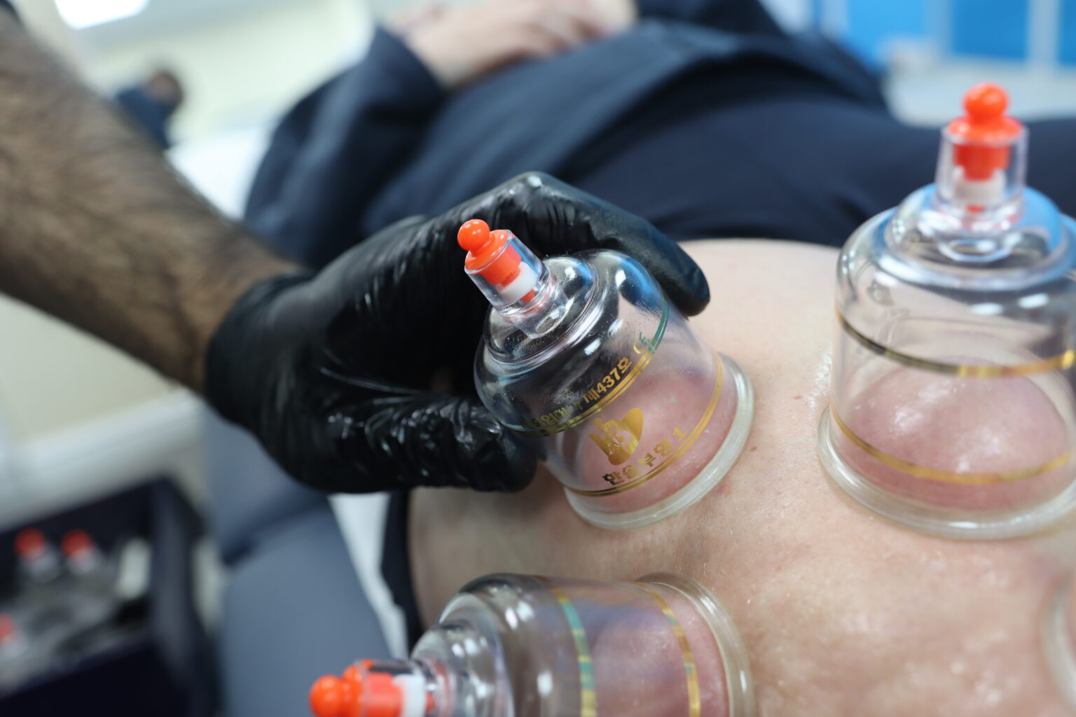 Cupping Physio Matters