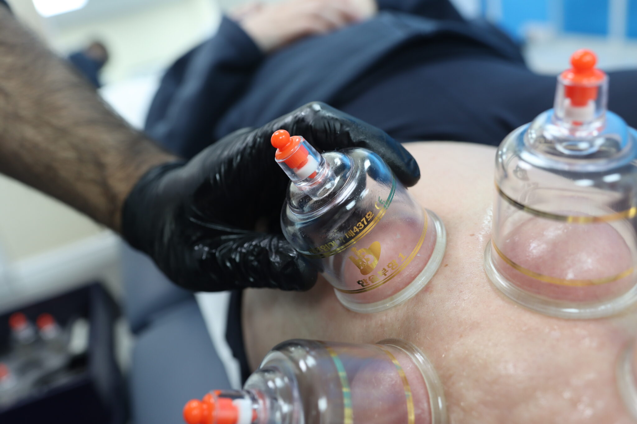 Cupping - Physio Matters